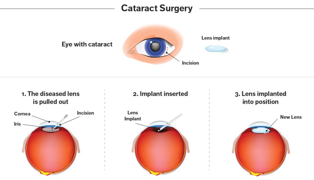 What Is Involved In Cataract Treatment? - Neighborgoods